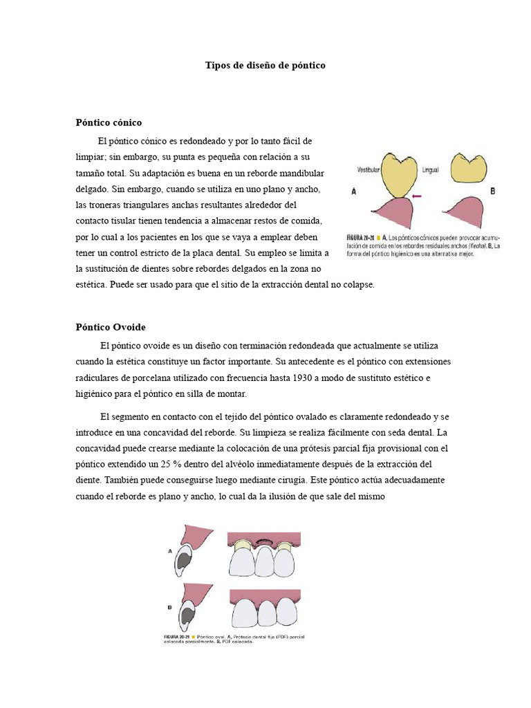 Tipos de Diseño de Póntico | PDF
