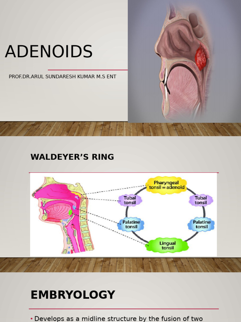 ADENOID | PDF | Human Nose | Respiratory System