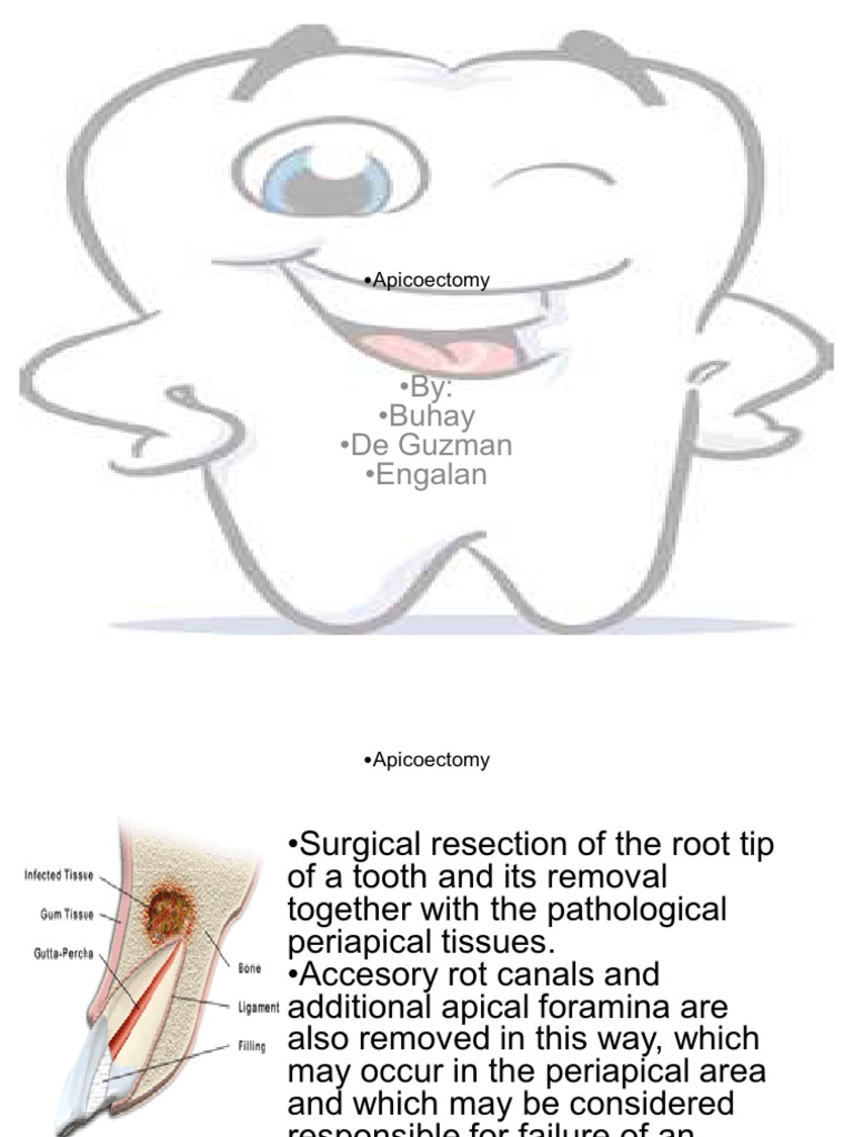 Apicoectomy: Indications and Techniques | PDF