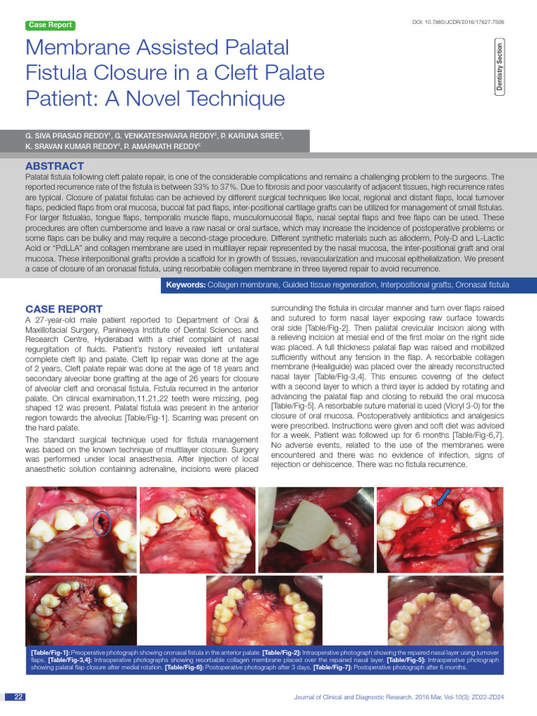 Membrane Assisted Palatal Fistula Closure in A Cle | PDF | Surgical ...