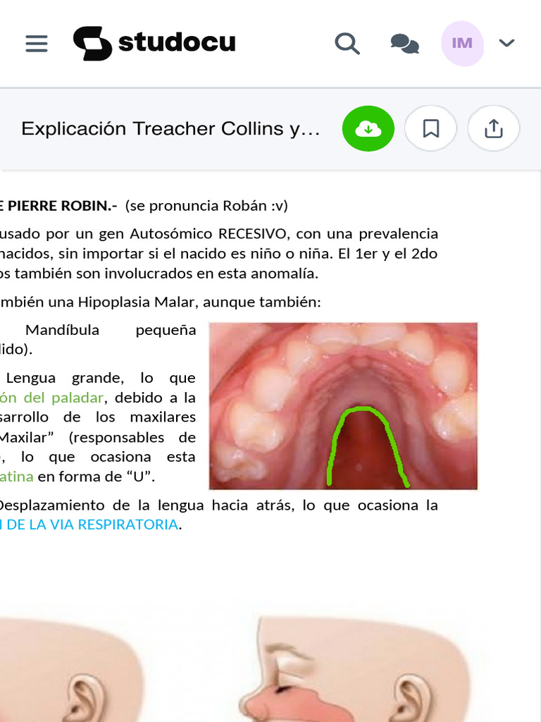 Explicación Treacher Collins y Pierre Robin - TREACHER COLLINS ...