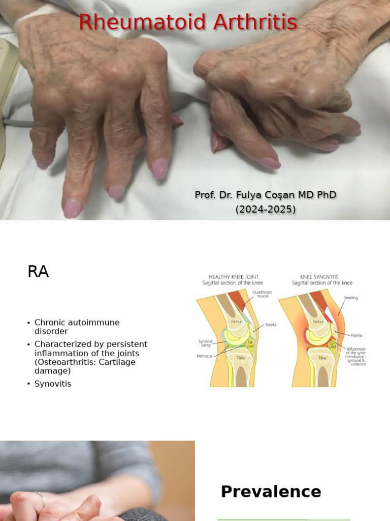 Understanding Rheumatoid Arthritis Deformities | PDF | Rheumatoid ...