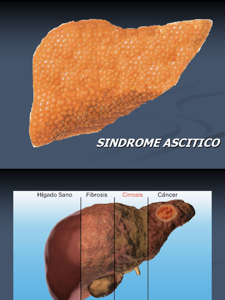 Síndrome Ascítico Edematoso y Diagnóstico | PDF | Cirrosis | Hipertensión