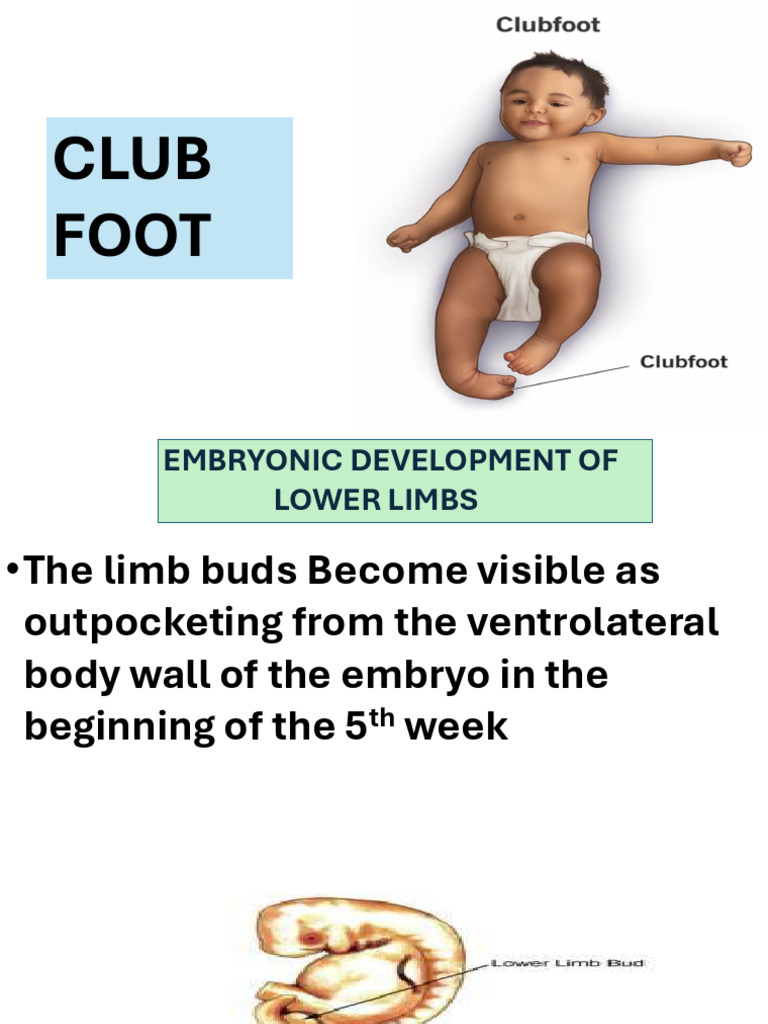 Club Foot | PDF | Foot | Medical Specialties
