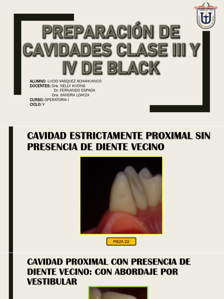 Preparación Cavidades Clase III y IV | PDF
