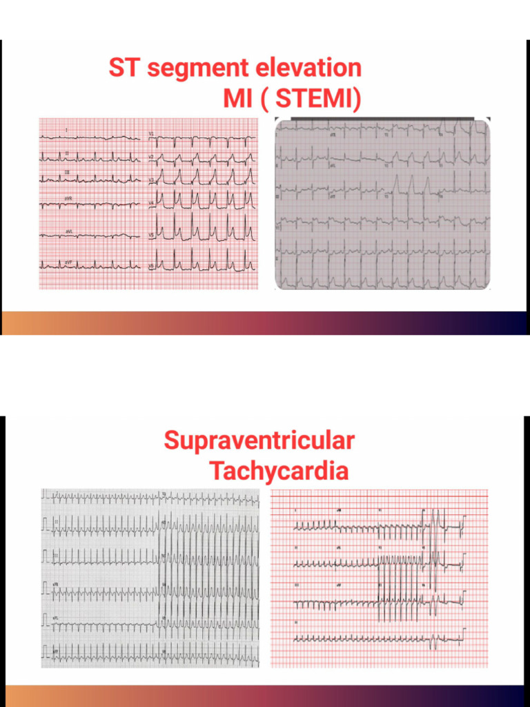 Ecg Solved | PDF