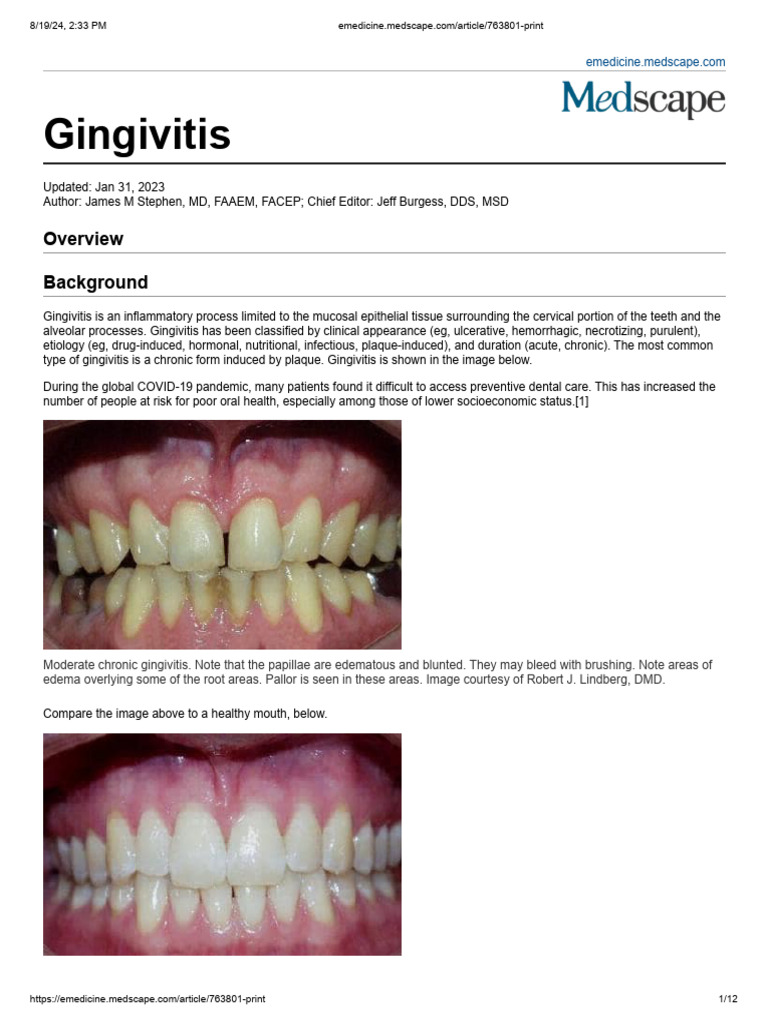Stages and Impact of Gingivitis | PDF | Periodontology | Oral Hygiene
