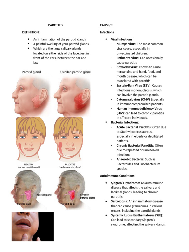 PAROTITIS | PDF | Saliva | Medical Specialties
