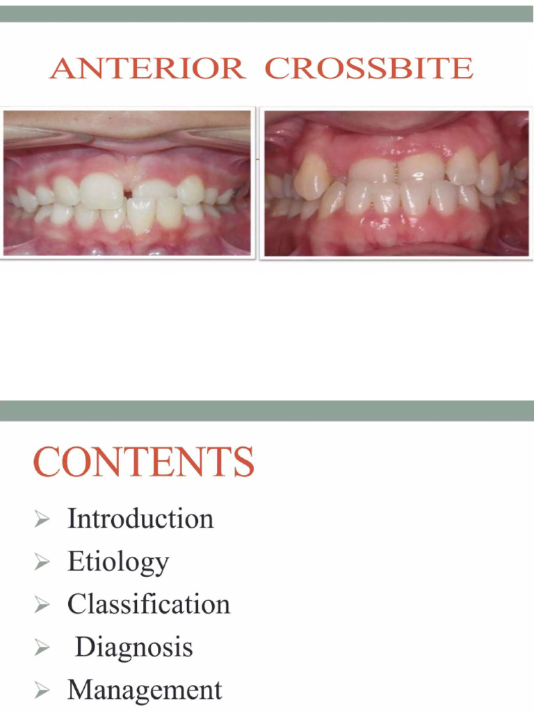 anterior crossbiteالحاضرة الثالثة - 052806 | PDF | Science & Mathematics