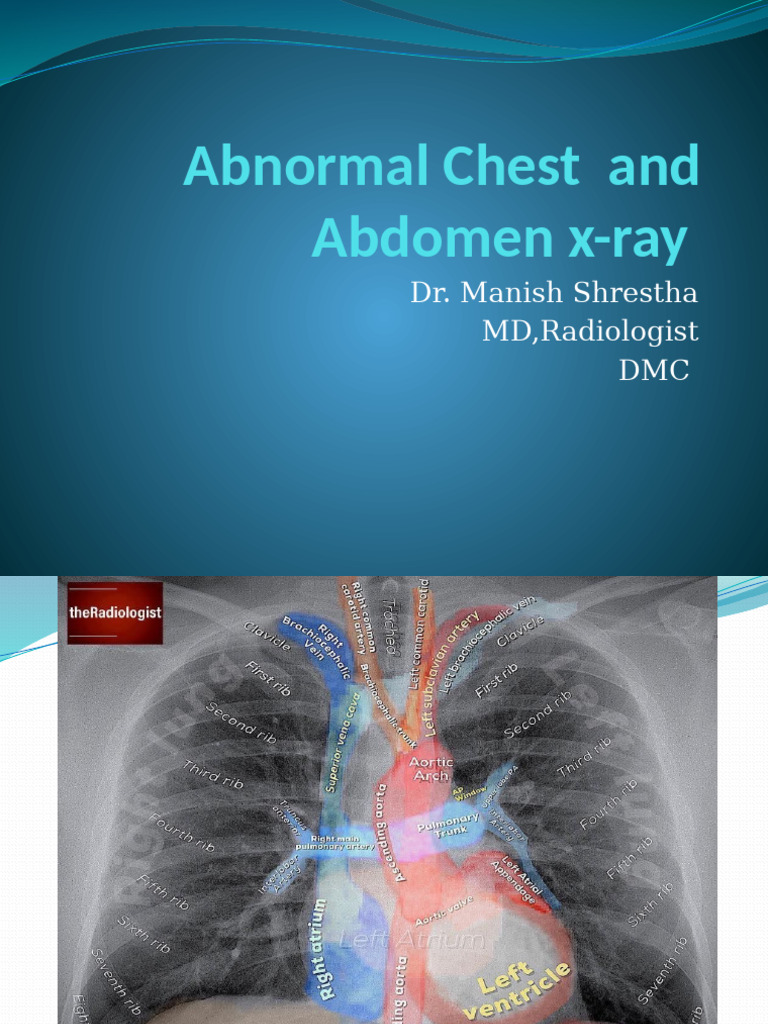 Abnormal Chest X-Ray Findings | PDF | Lung | Clinical Medicine