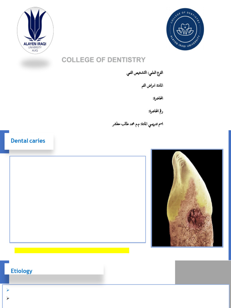 Oral Patho Lec.2 Dental Caries p.1 | PDF | Human Tooth | Tooth Enamel