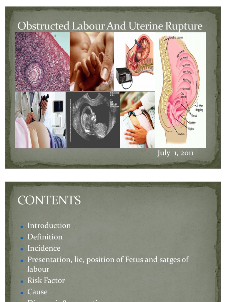 Seminar On Obstructed Labour | PDF | Childbirth | Pelvis