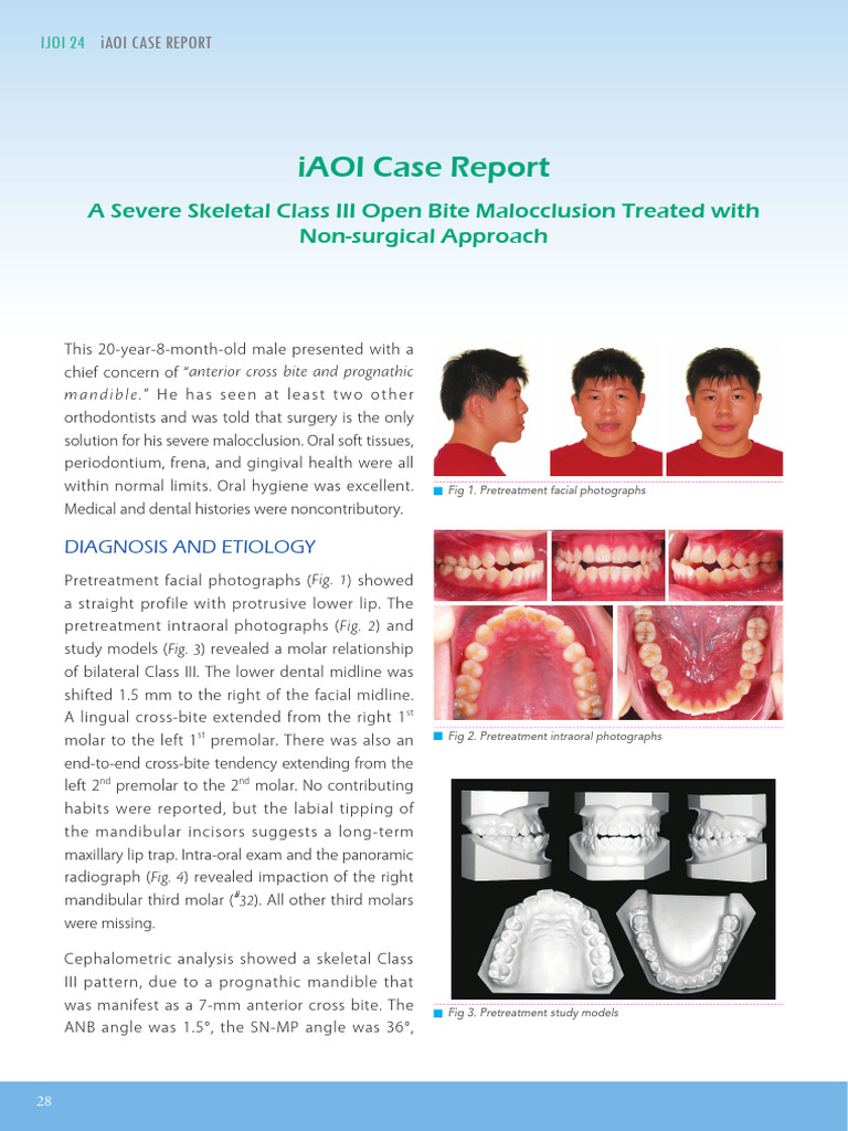 Severe Class III in Adult With Non-Surgical Approach | PDF ...