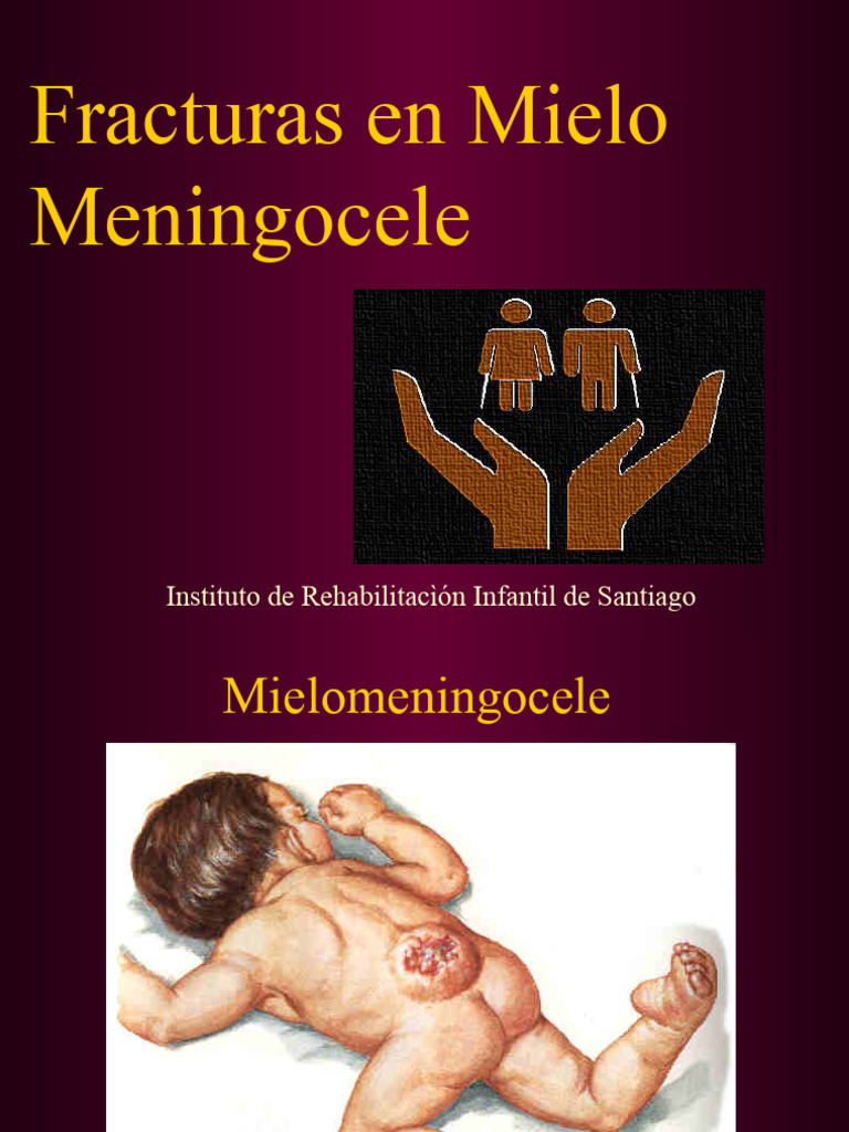 Fractura en Mielomeningocele | PDF | Medicina CLINICA | Sistema esquelético