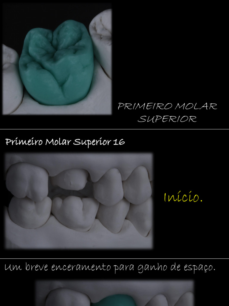 Anatomia do Primeiro Molar Superior | PDF | Dente | Anatomia dental