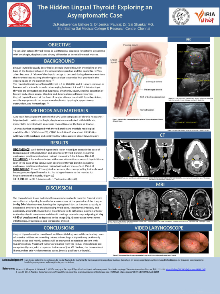 Eposter Verical Poster 1 | PDF | Thyroid | Tongue