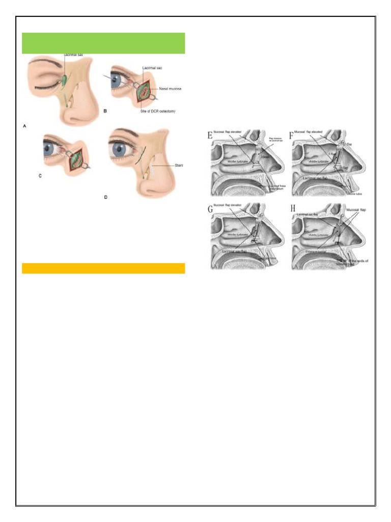 Dacryocystitis 4-Dcr and DCT | PDF | Surgical Suture | Surgery