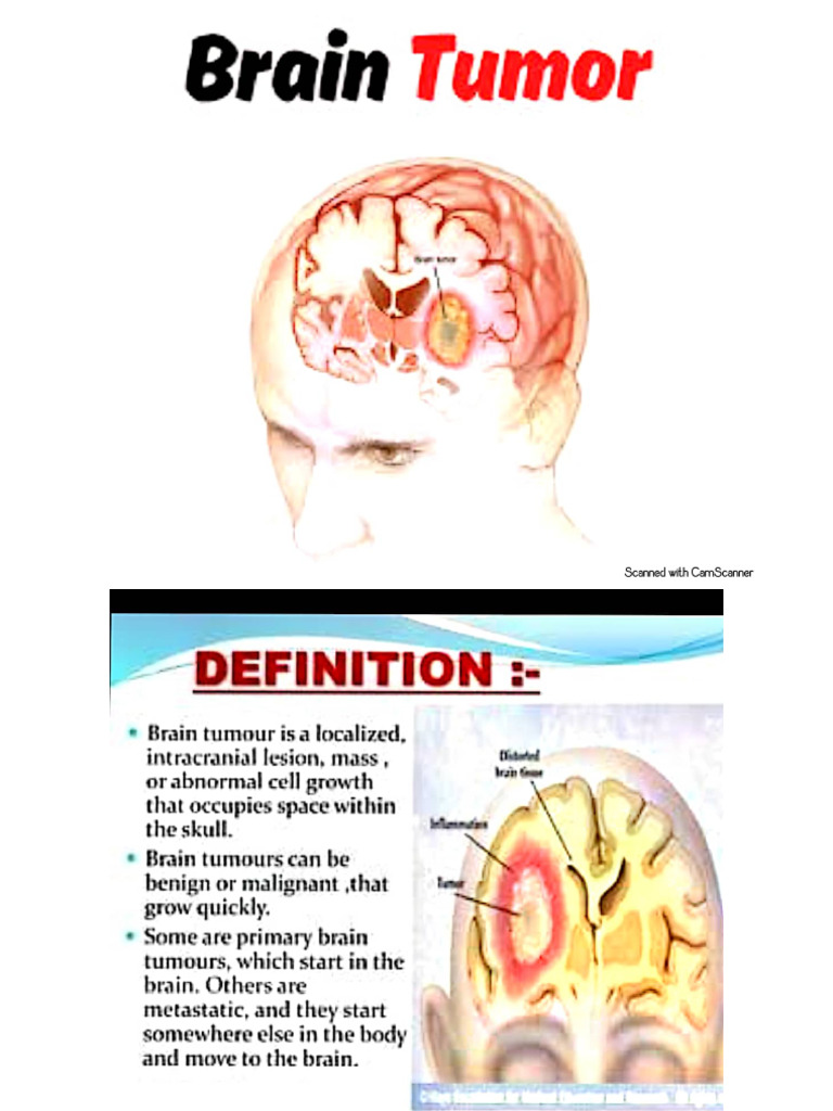 Brain Tumor | PDF