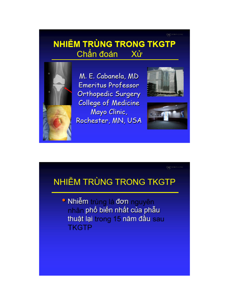 Infected TKA Trans | PDF