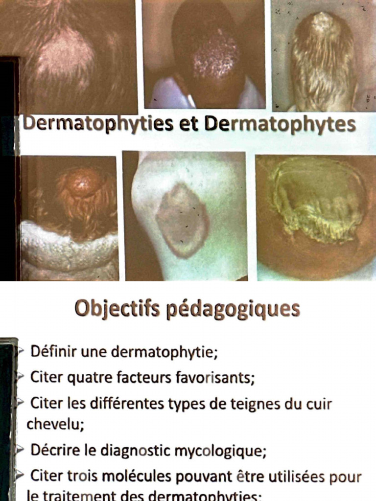 Dermatophyties Et Dermatophytes | PDF