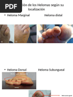 Onicectomia | PDF | Clavo (anatomía) | Dedo del pie