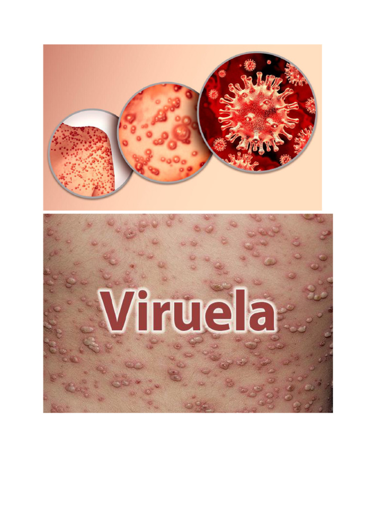 La Viruela | PDF
