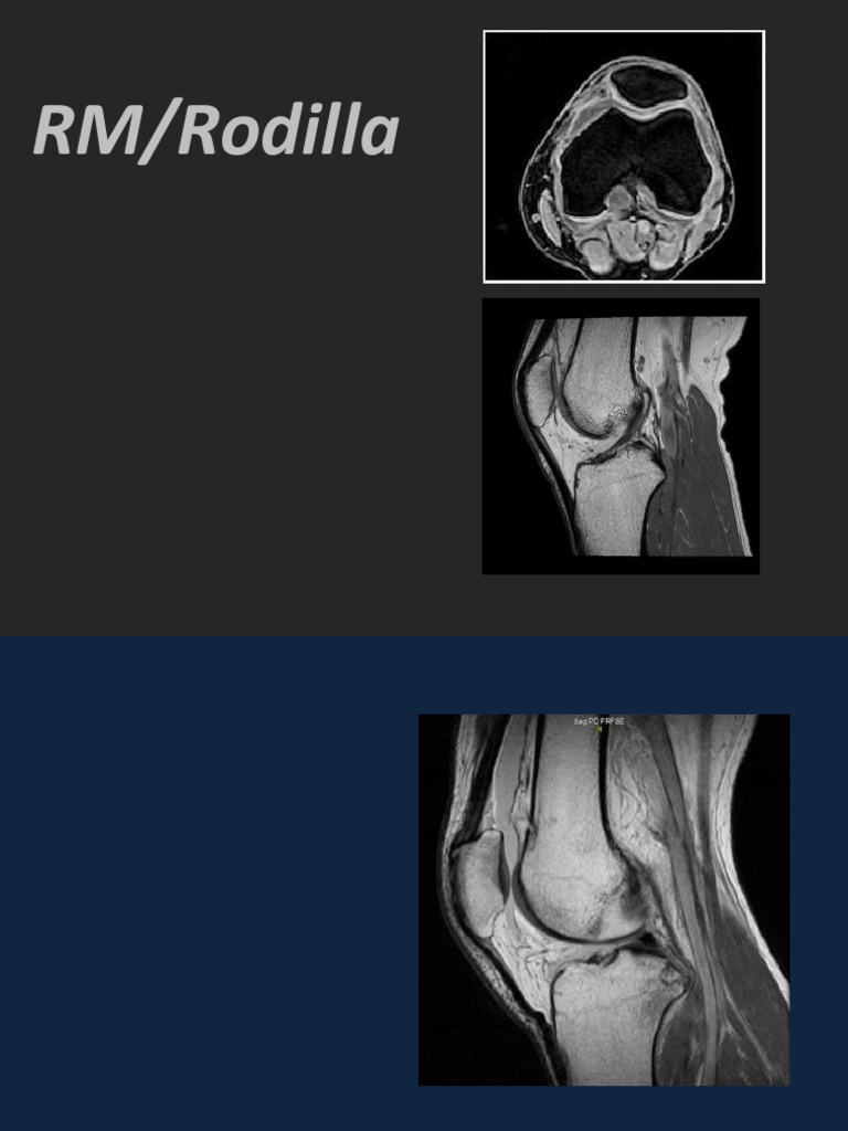 Diagnóstico de RM de Rodilla: Meniscos y Ligamentos | PDF | Rodilla | Anatomía humana