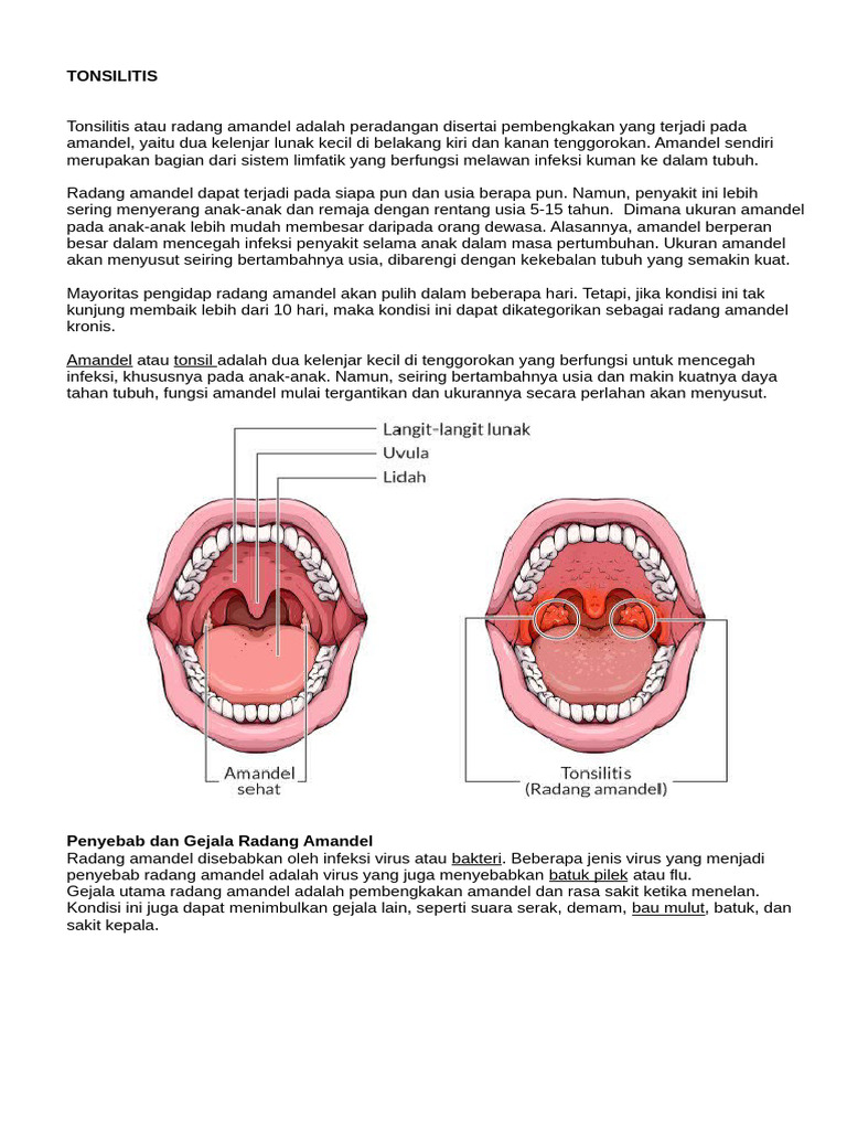 TONSILITIS | PDF | Sains & Matematika