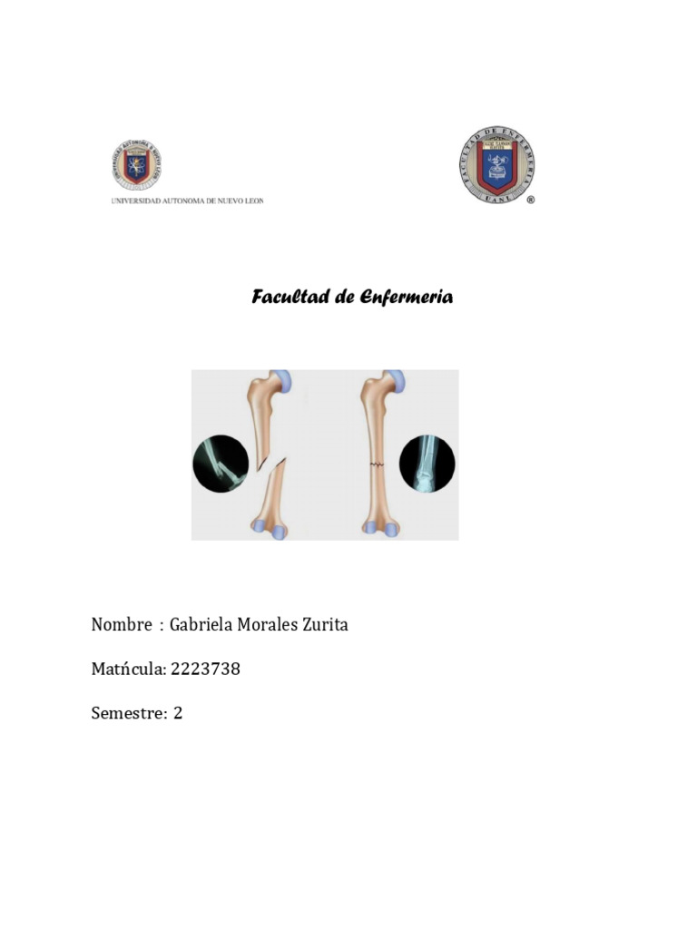 Tipos y tratamiento de fracturas óseas | PDF | Hueso | Artritis