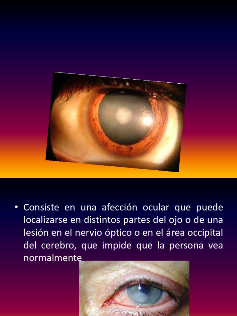 Deterioro Visual: Impacto en Niños | PDF | Discapacidad visual | Percepción