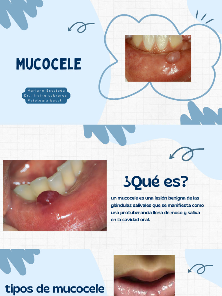 Guía sobre Mucoceles en la Cavidad Oral | PDF | Estudios de idiomas ...