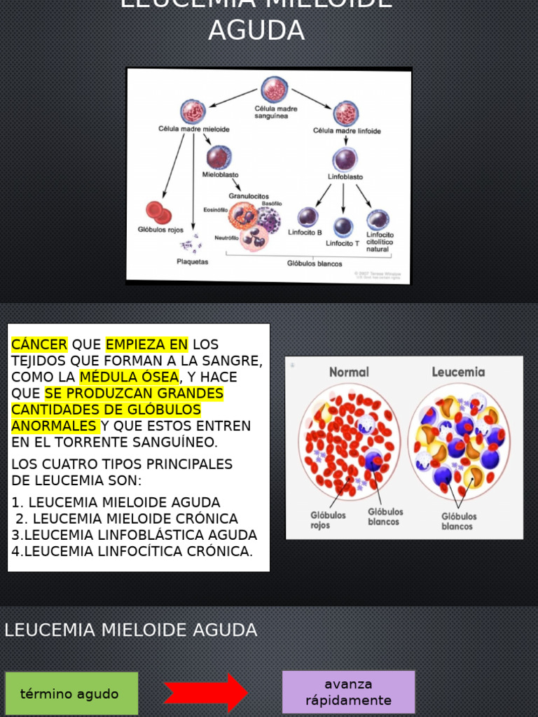 Leucemia Mieloide Aguda | PDF | Leucemia | Sangre