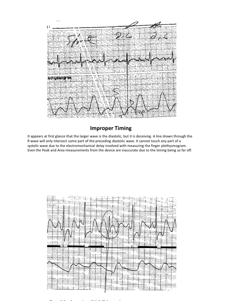 EECP ECG Triggering Troubleshooting | PDF