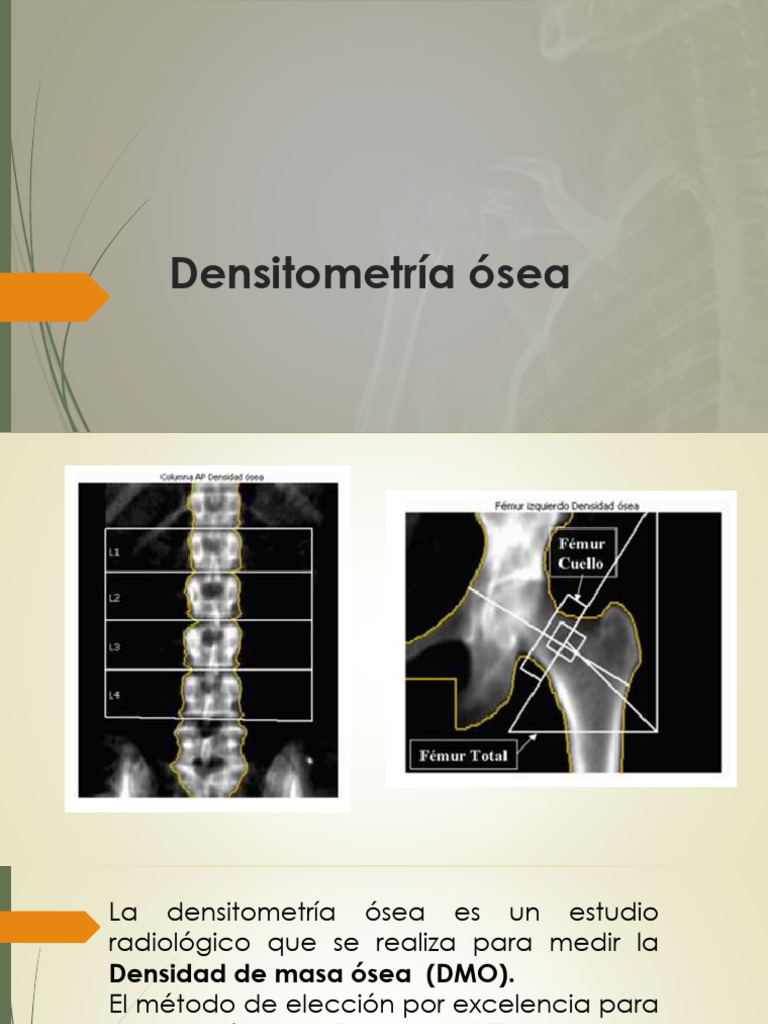 Densitometría Ósea: Interpretación y Uso | PDF | Osteoporosis ...