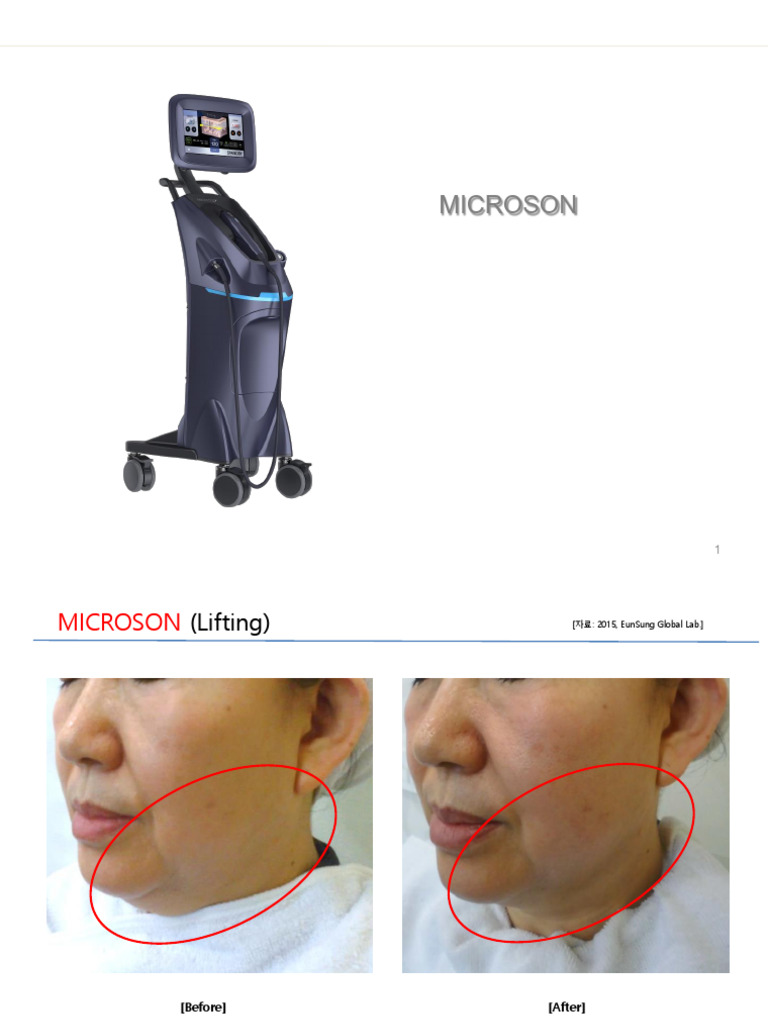 Hifu Microson Rezultate Tratamente | PDF
