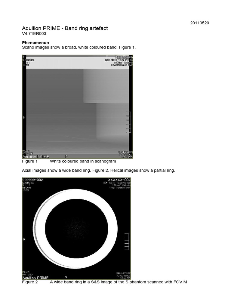 Aquilion PRIME - Band Ring Artefact | PDF