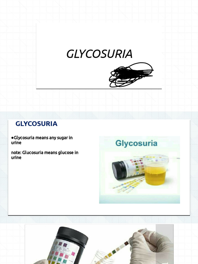 Types and Causes of Glycosuria | PDF | Science & Mathematics | Lifestyle