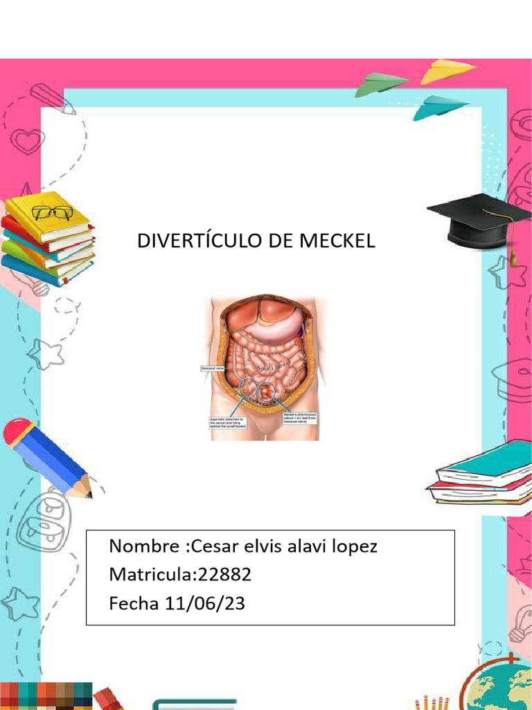 Divertículo de Meckel | PDF | Abdomen | Tracto gastrointestinal