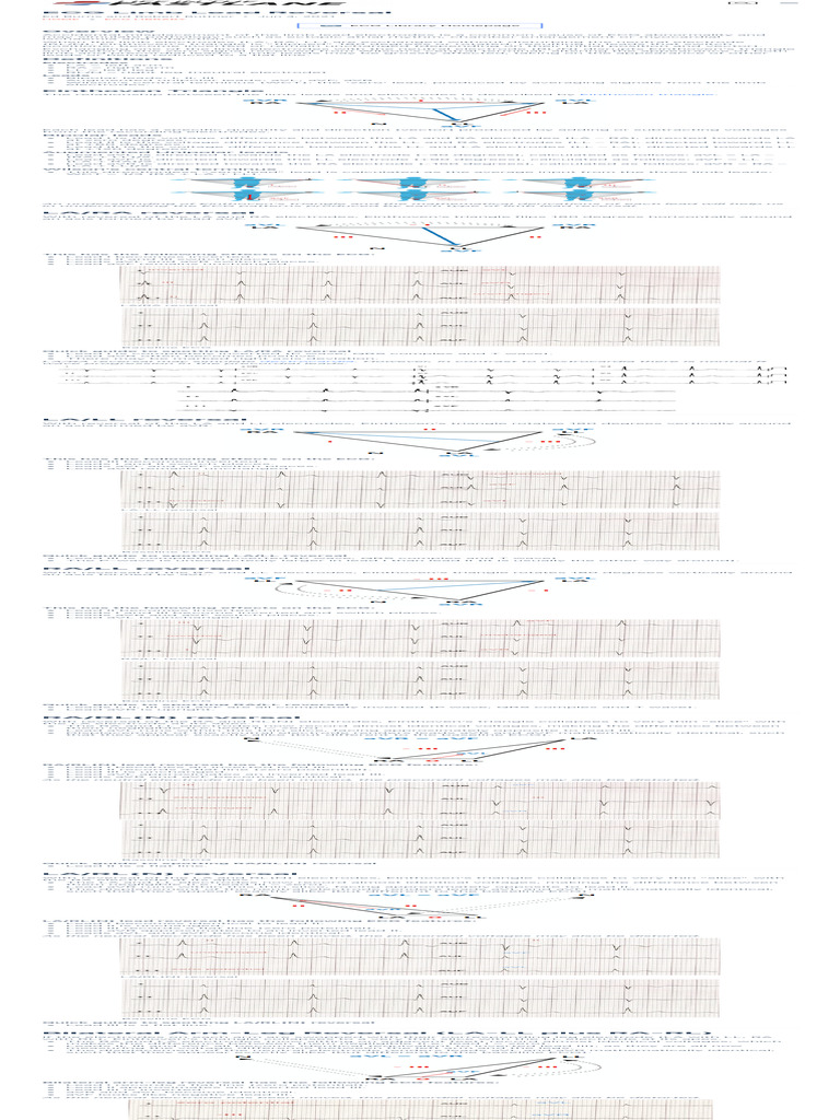 ECG Limb Lead Reversal - LITFL - ECG Library Diagnosis | PDF ...