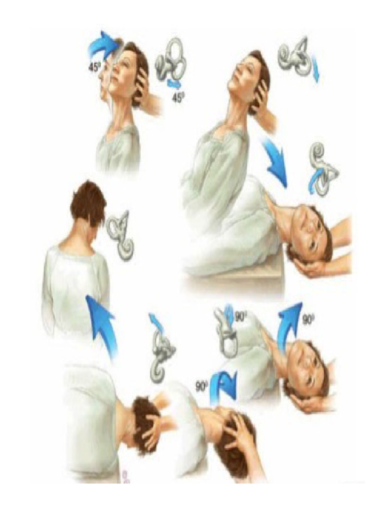 Maniobra de Epley | PDF