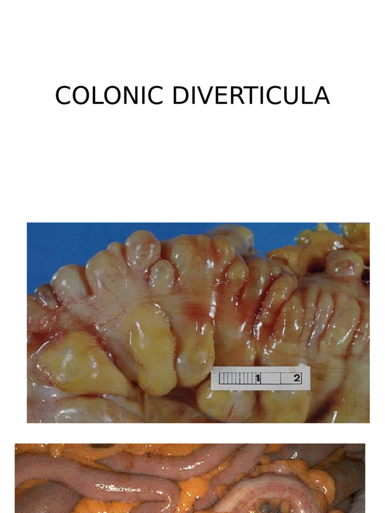 Colonic Diverticula | PDF | Science & Mathematics