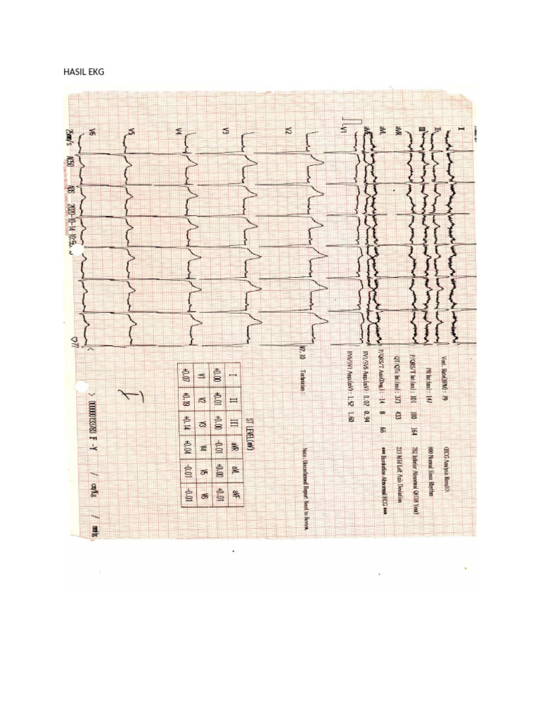 Hasil Ekg | PDF