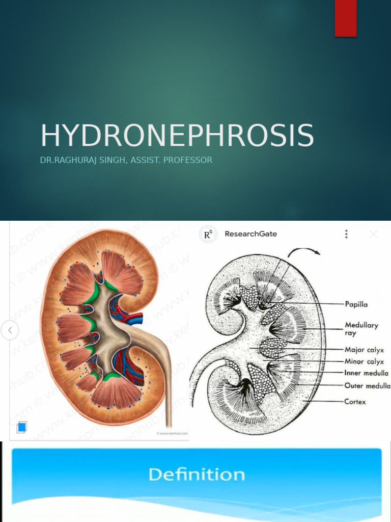 Hydronephrosis | PDF