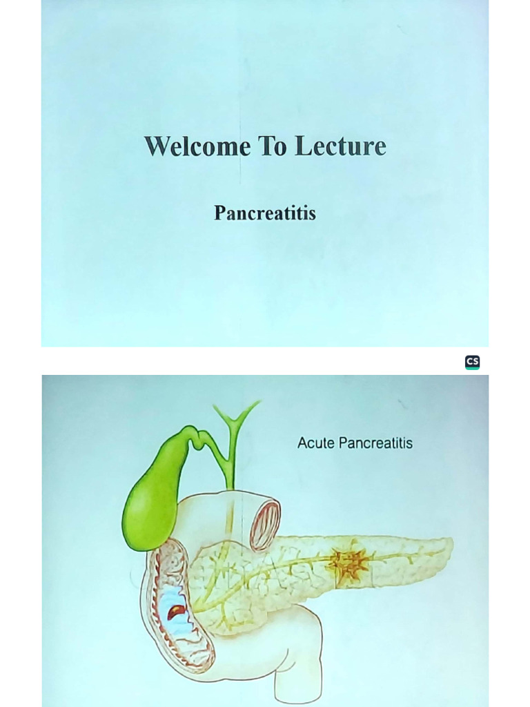 Acute Pancreatitis @surgery | PDF