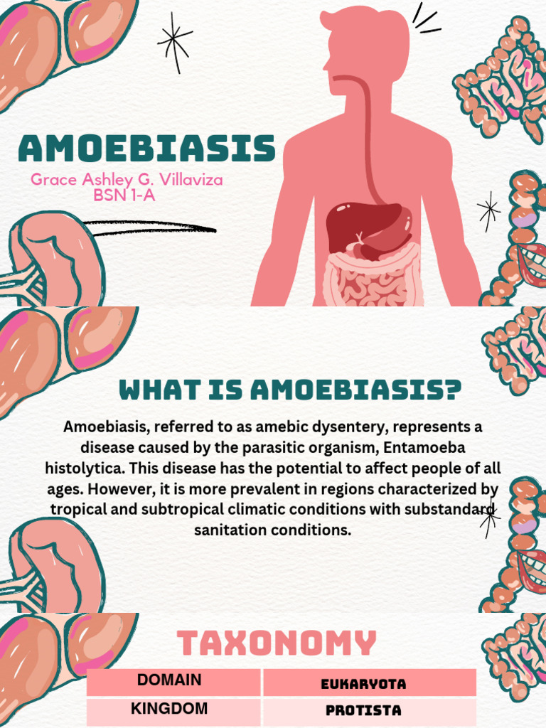Case Study On Amoebiasis Grace Ashley Villaviza | PDF | Medical Specialties | Clinical Medicine
