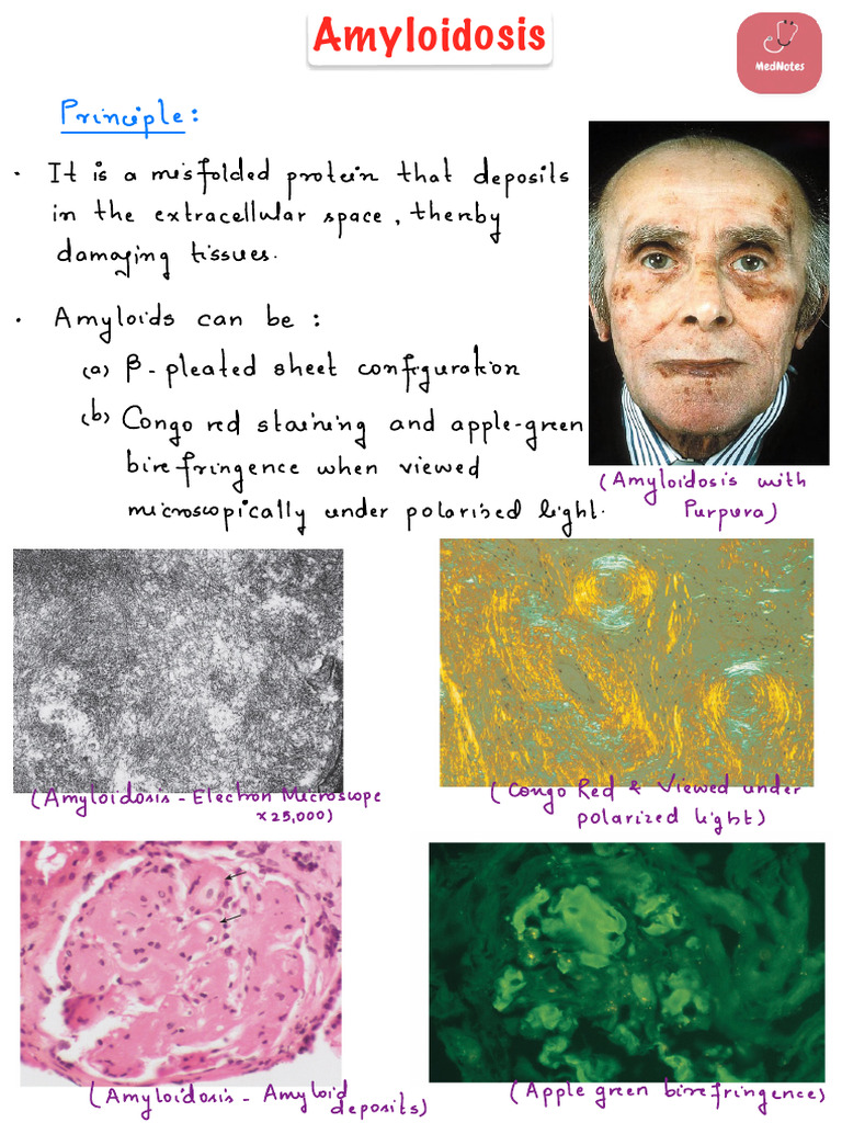 Amyloidosis | PDF | Human Diseases And Disorders | Causes Of Death