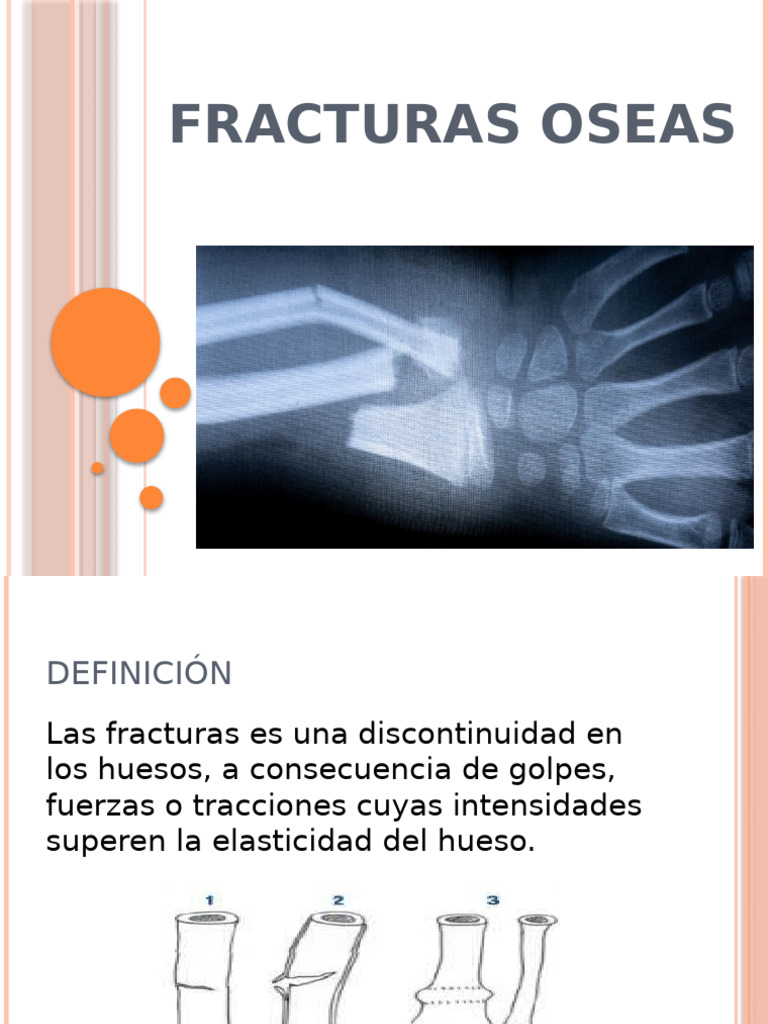 Fracturas Oseas Pdf Hueso Embolia