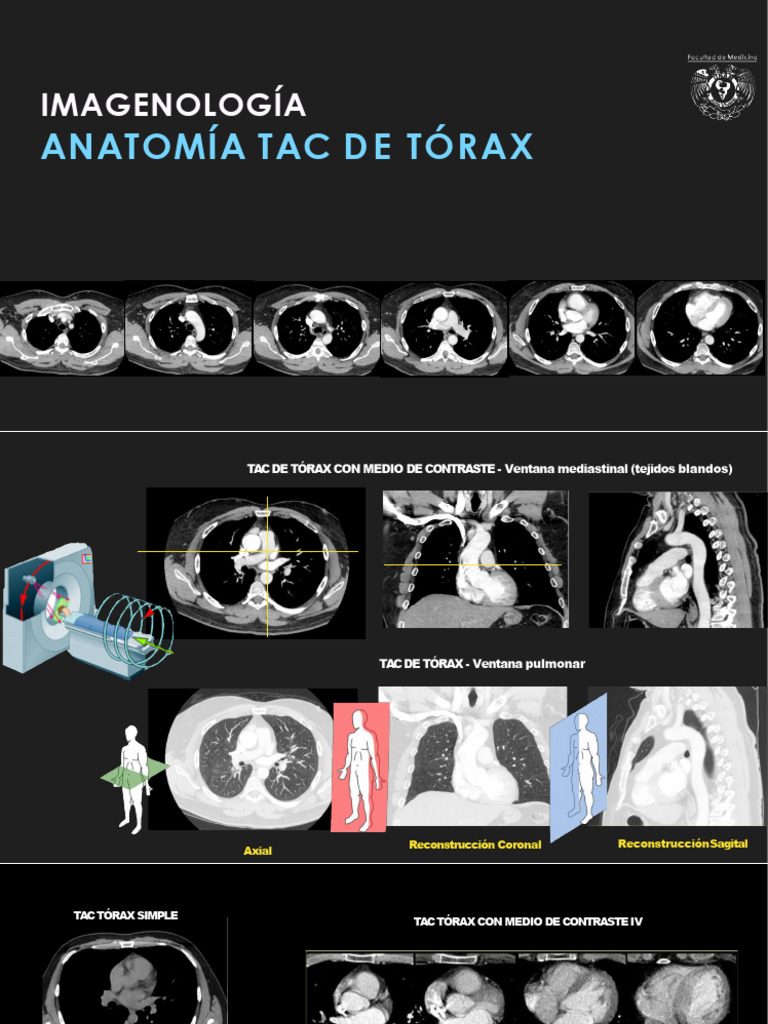 Anatomía y TAC de Tórax Detallado | PDF | Pulmón | Corazón