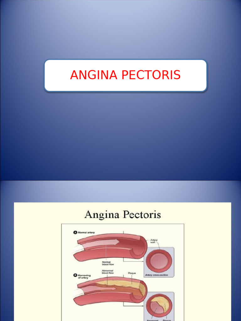Angina Pectoris | PDF | Coronary Artery Disease | Causes Of Death