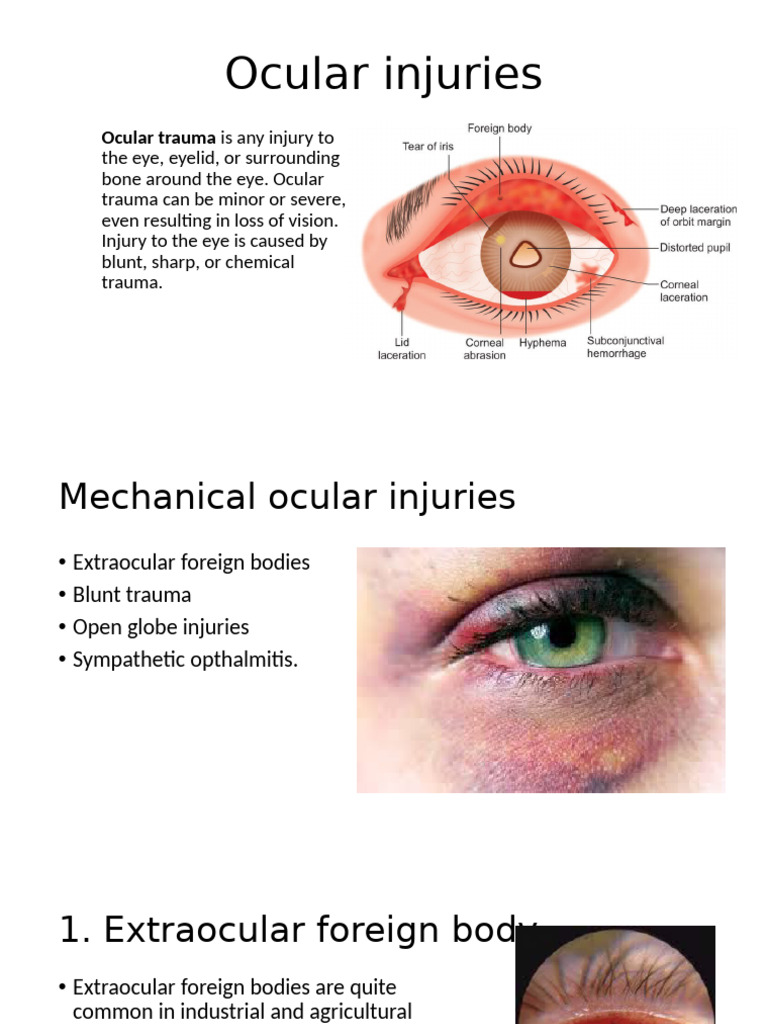 Ocular Trauma: Types and Treatments | PDF | Cornea | Human Eye